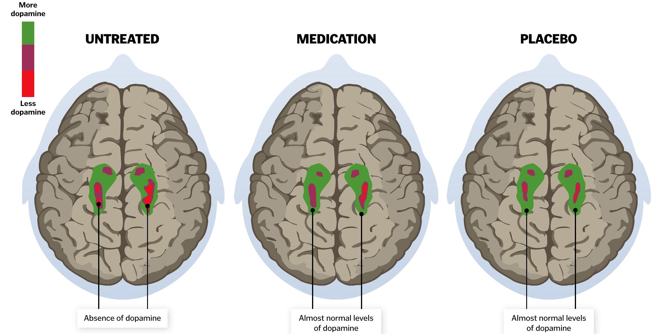 Placebo Effect Diagram True Experiment: Definition & Examples Video
